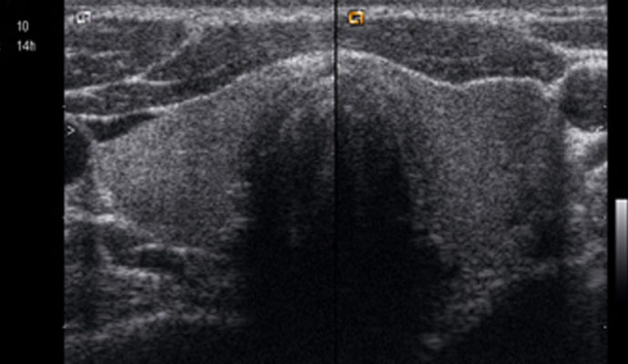 sono struma - Schilddrüse 360